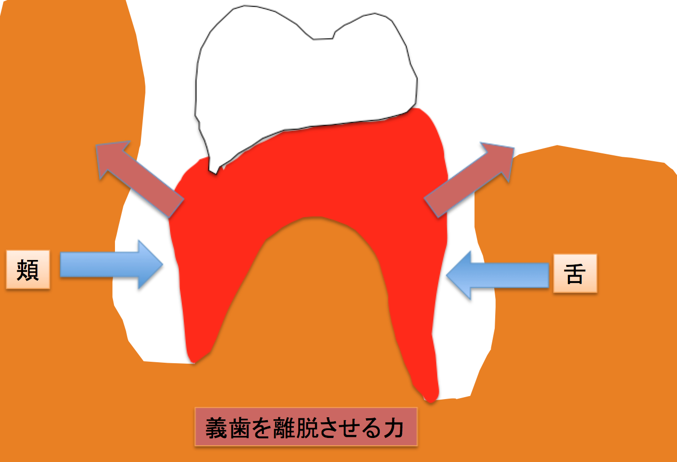 入れ歯について知ろう−その25−入れ歯の歯肉の形で入れ歯の安定さが変わる!|吹田市寿町の歯医者|よしなか歯科クリニック